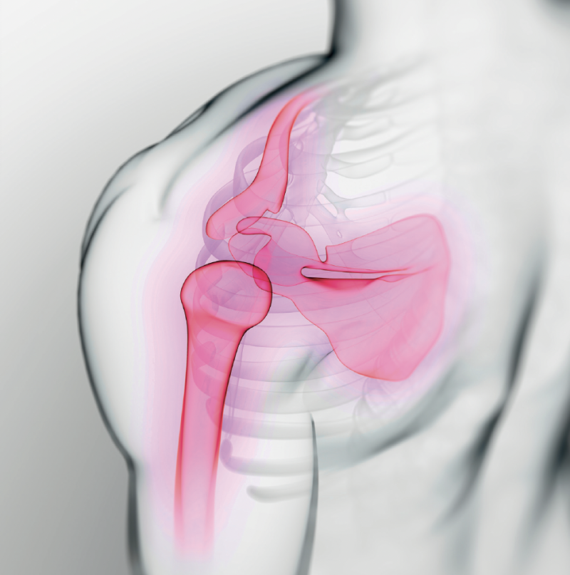 Capsulite rétractile ("épaule gelée") — Wikimedecine