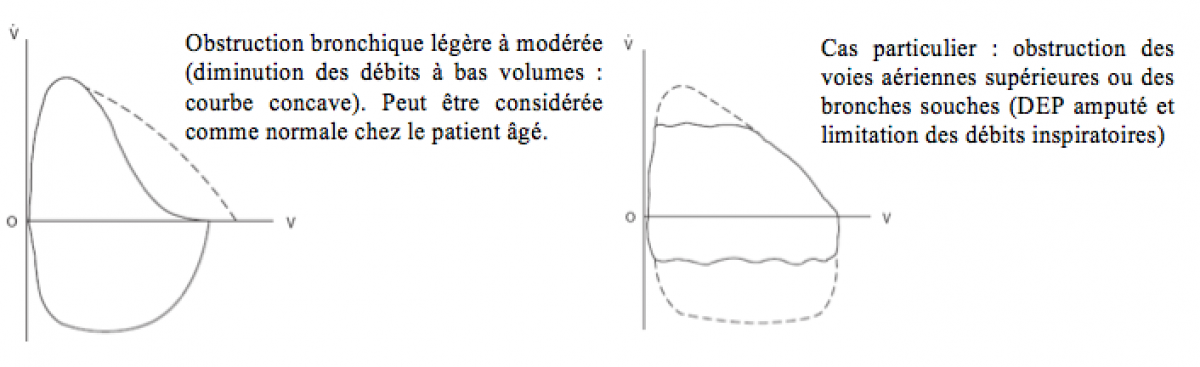Epreuves fonctionnelles respiratoires (EFR) - éléments d'interprétation ...