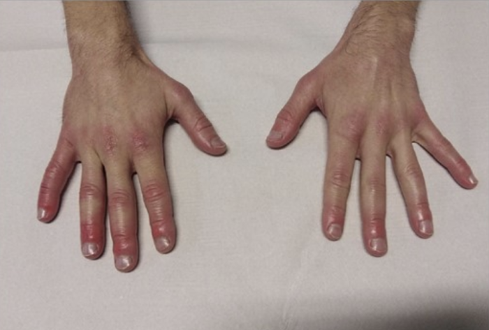 Engelures — Wikimedecine