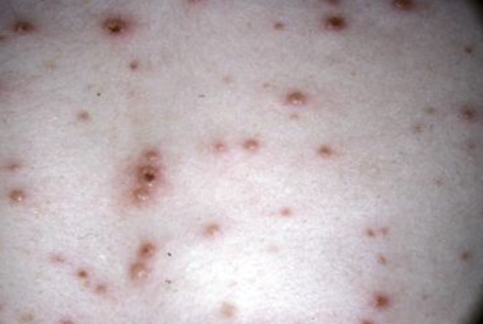 Varicelle — Wikimedecine