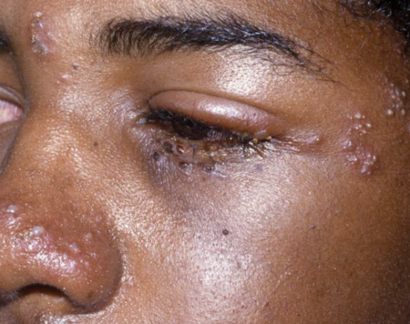 Zona — Wikimedecine